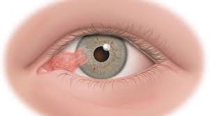 Córnea e superfície ocular - Visium Oftalmologia